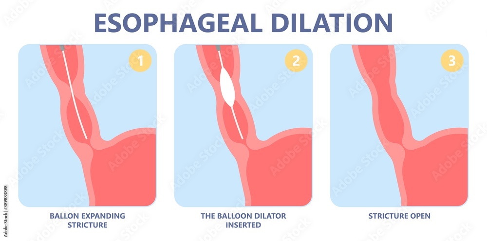 Dysphagia infection trachea examine Surgery choking gastric diagnose ...
