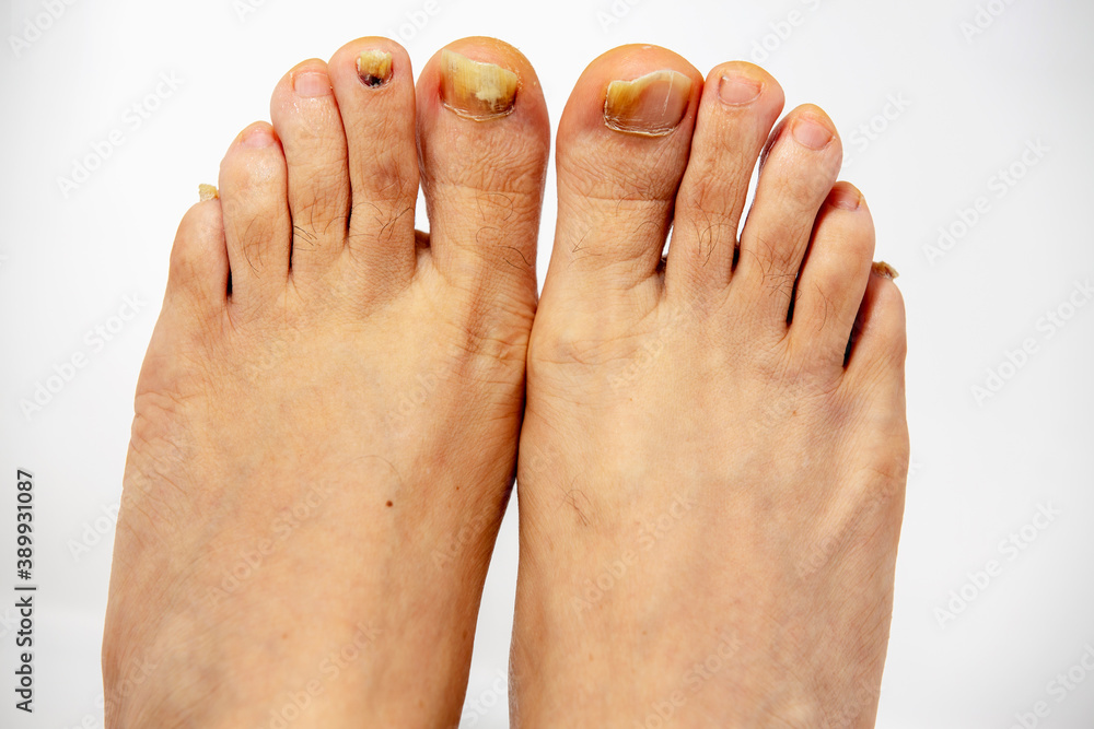 Men foot with callus on big toe and on small toes and a case of fungal ...