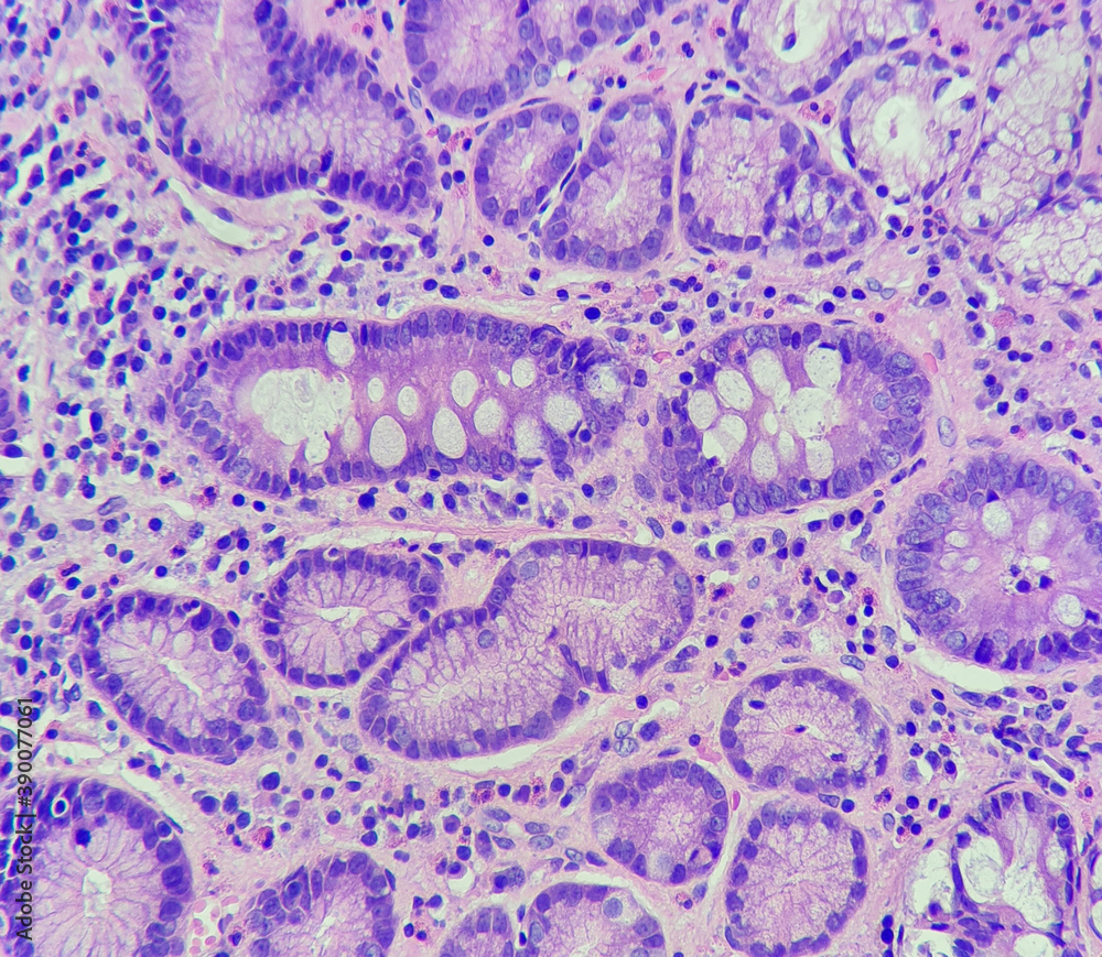 Foto de This gastric mucosa reveals focal intestinal metaplasia ...
