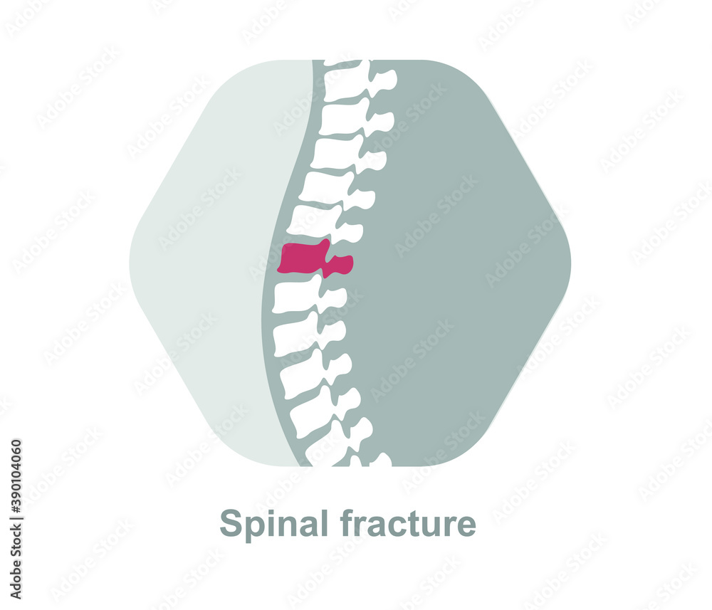 Spine Fracture and traumatic vertebral injury medical concept, on white ...