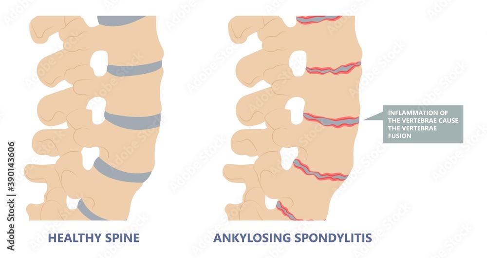 Ankylosing Spondylitis osteoporosis Skeletal pelvis Stiffness chronic ...