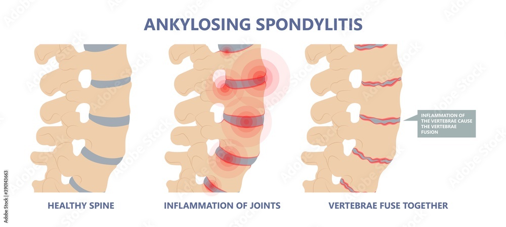 Ankylosing Spondylitis osteoporosis Skeletal pelvis Stiffness chronic ...