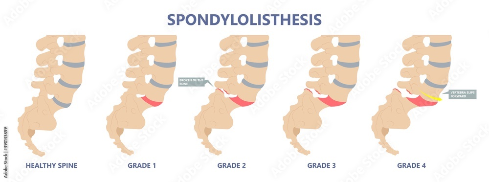 Spondylolisthesis a spinal disease that causes one of the lower ...