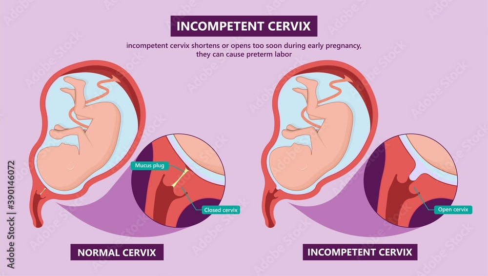 Incompetent cervix cervical insufficiency weak tissue premature stitch ...