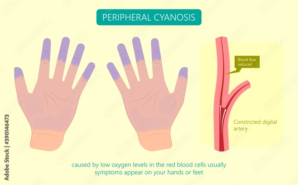 Peripheral cyanosis symptoms of low oxygen levels in the red blood ...