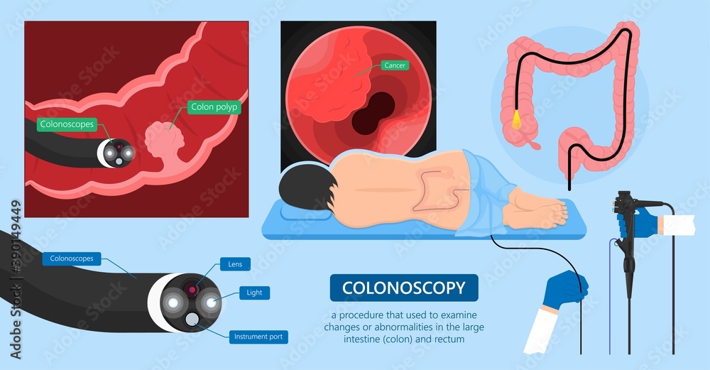 Polypectomy procedure to remove polyps from the colon medical Stock ...