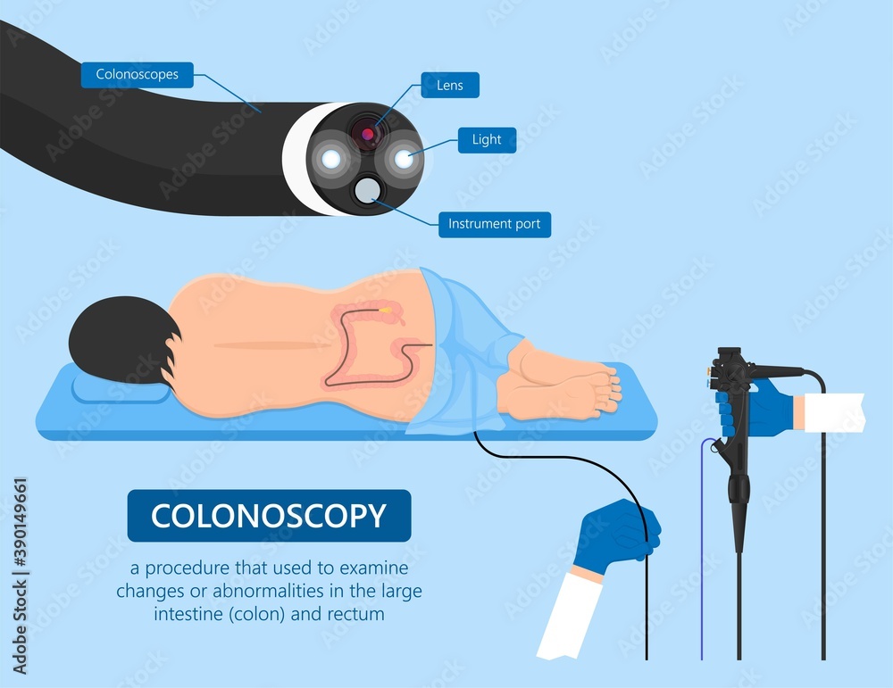 Polypectomy procedure to remove polyps from the colon medical Stock ...