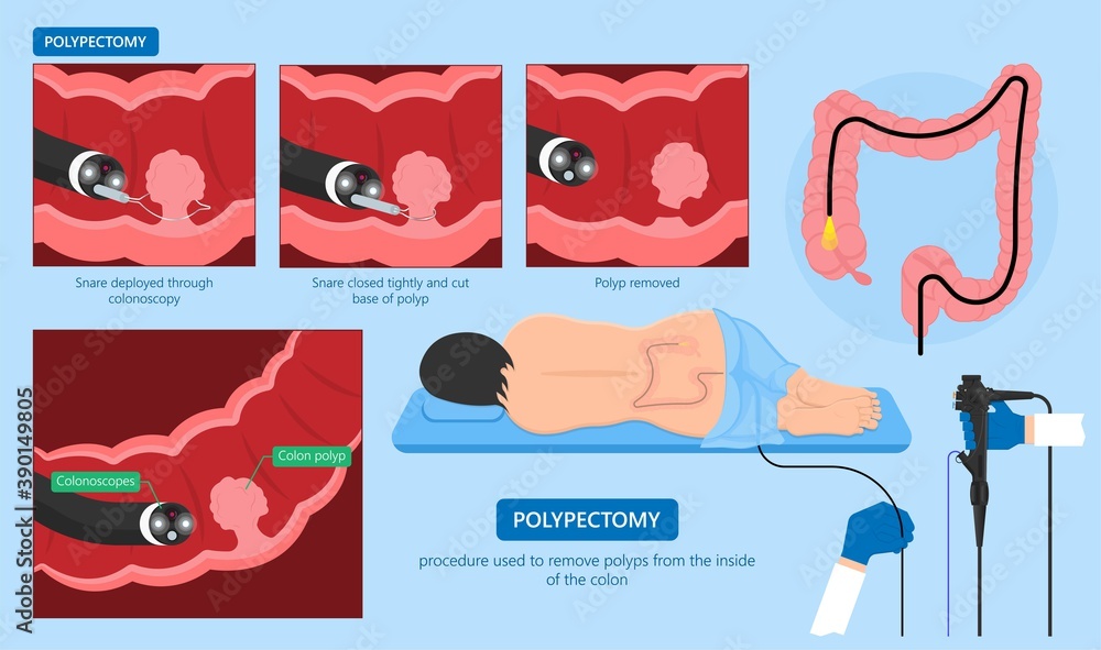 Polypectomy procedure to remove polyps from the colon medical Stock ...