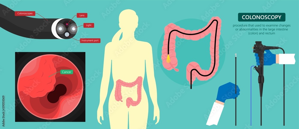 Photo & Art Print Polypectomy procedure to remove polyps from the colon ...