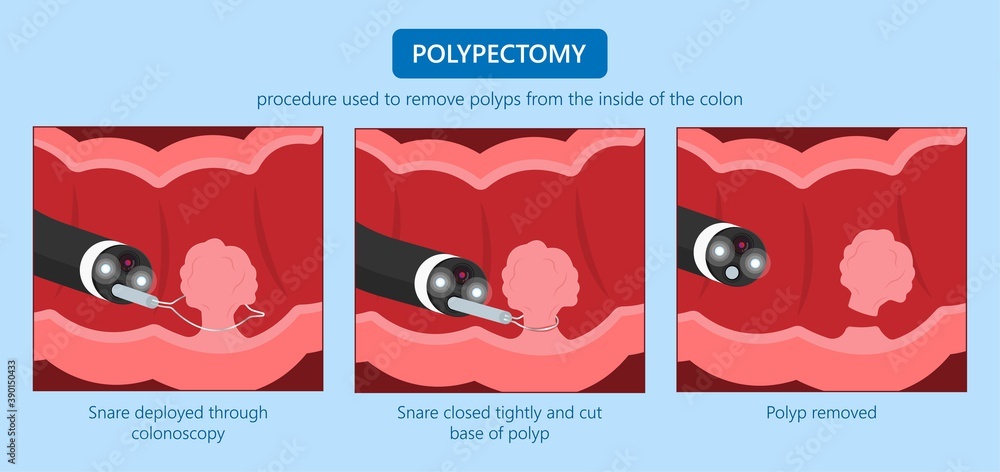 Polypectomy procedure to remove polyps from the colon medical Stock ...