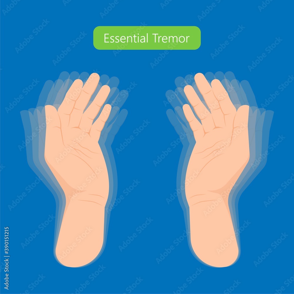 Essential tremor Deep brain stimulation DBS surgery device implant ...