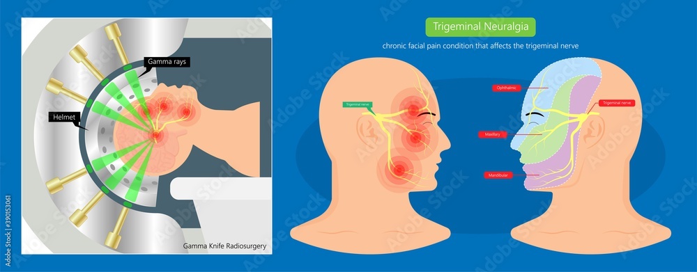 Trigeminal neuralgia chronic pain of facial TMD injury ophthalmic ...