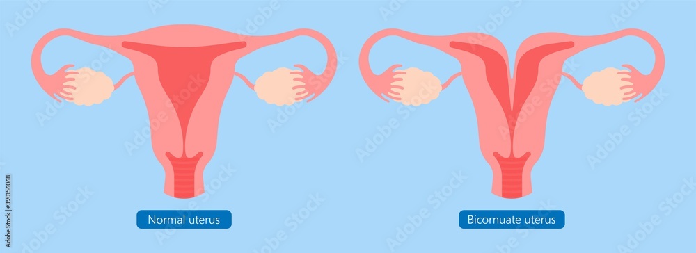 Abnormale baarmoeder Getipt septum gemiste volwassen baarmoederhals ...