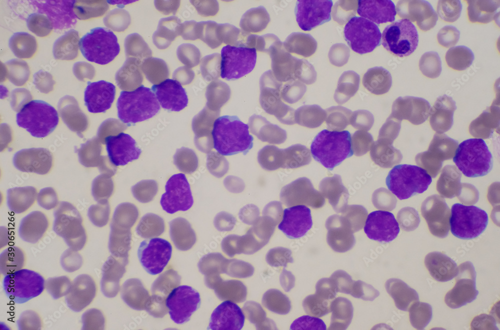 Moderate blast cell of white blood cells in blood smear. Stock Photo ...