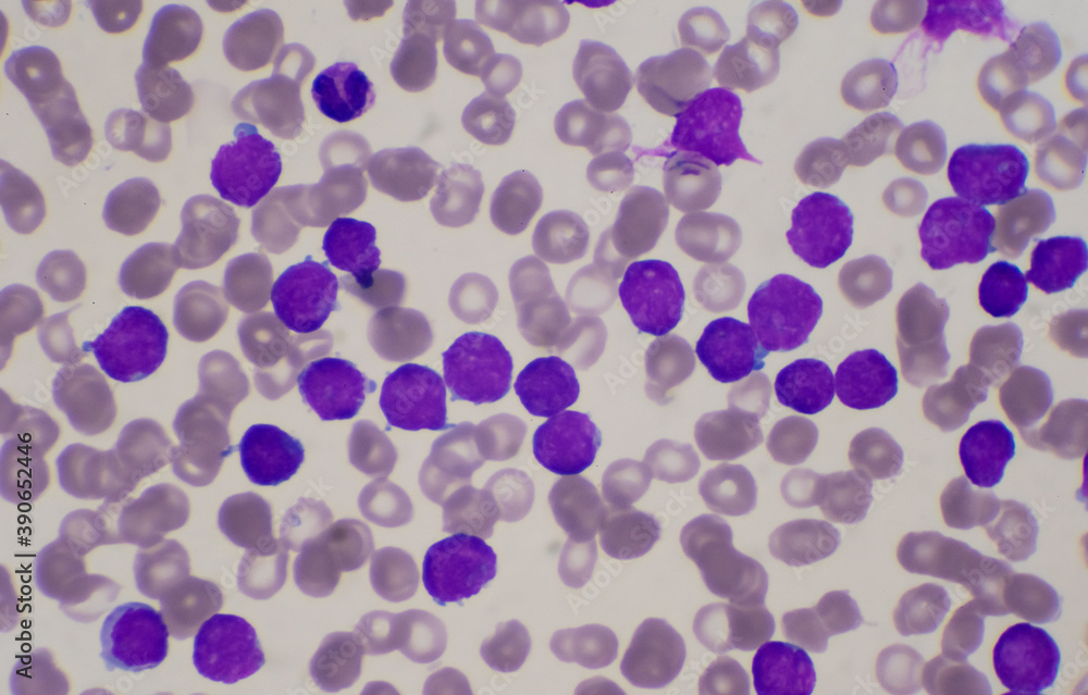 Moderate blast cell of white blood cells in blood smear. Stock Photo ...