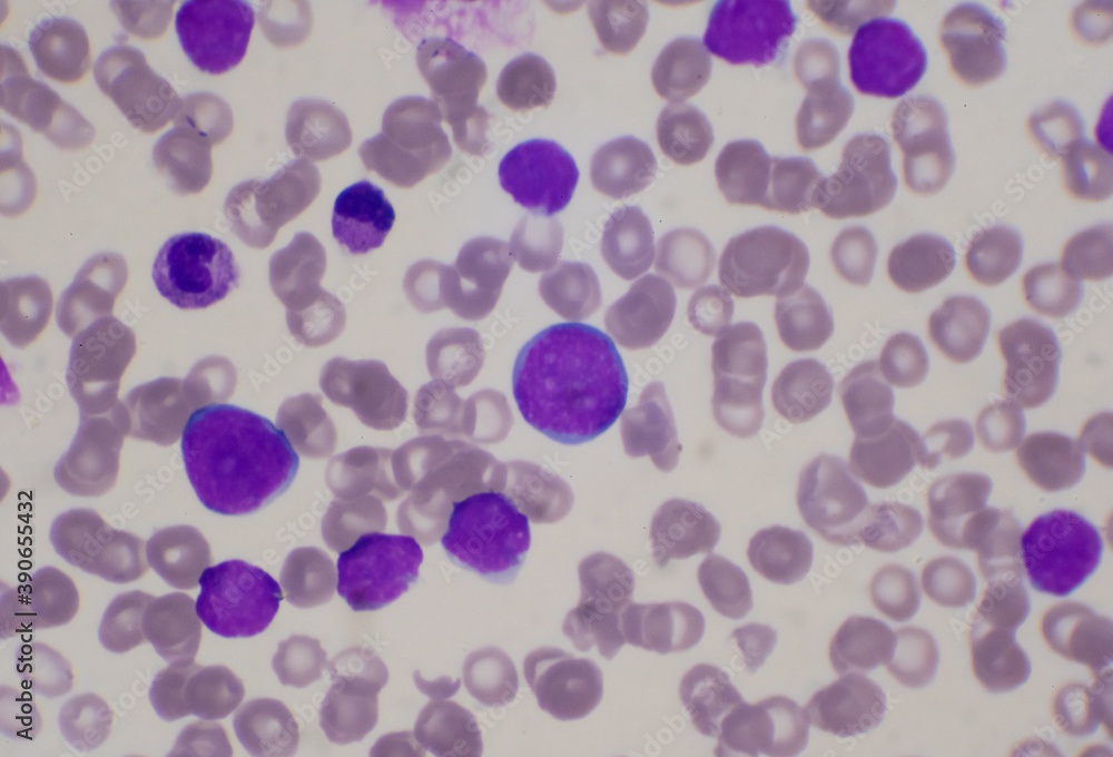 Moderate blast cell of white blood cells in blood smear. Stock Photo ...
