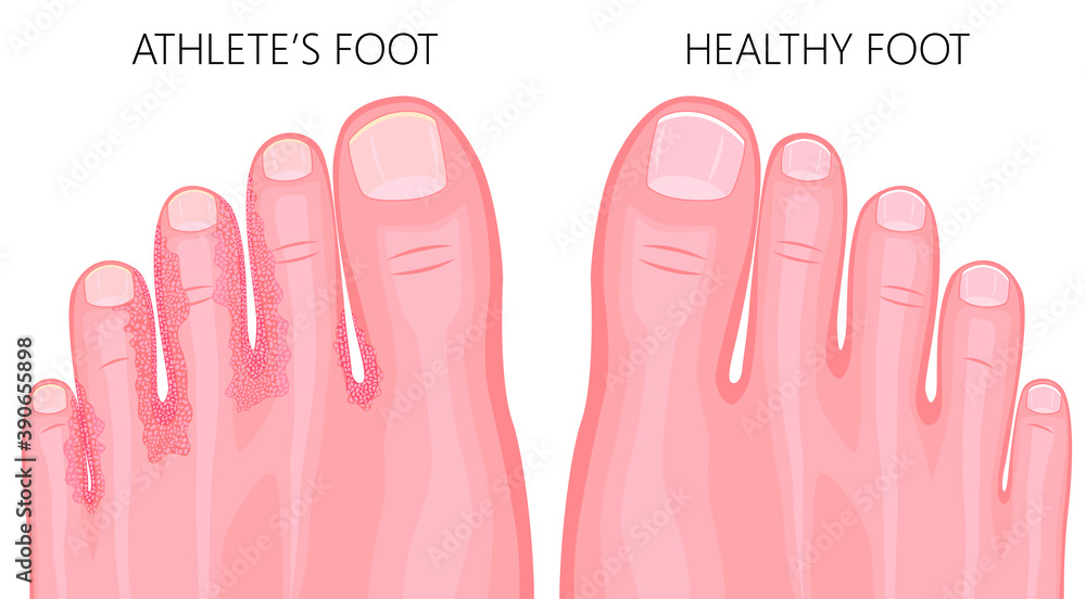 Illustration of healthy foot and Athlete s foot or tinea pedis (tpo of ...