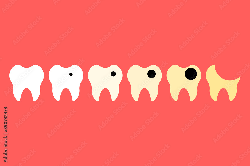 Caries formation illustration. Tooth decay step by step process of and ...