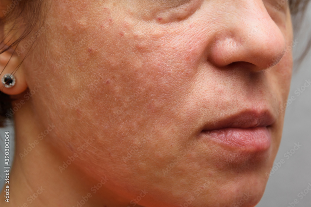 Caucasian brunette woman face skin after biorevitalization procedure ...