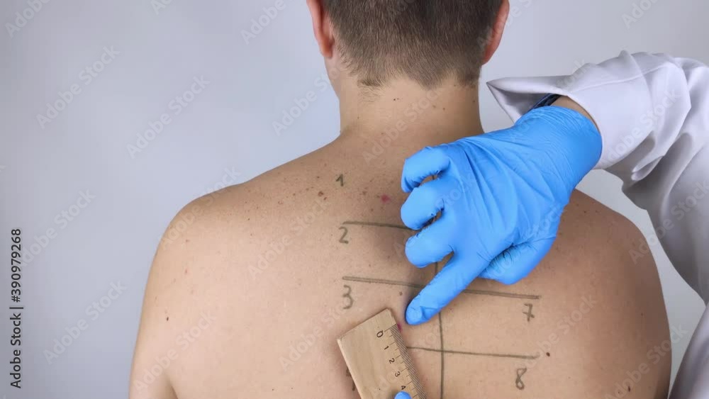 An allergist or dermatologist examines red spots on a man’s face. The ...