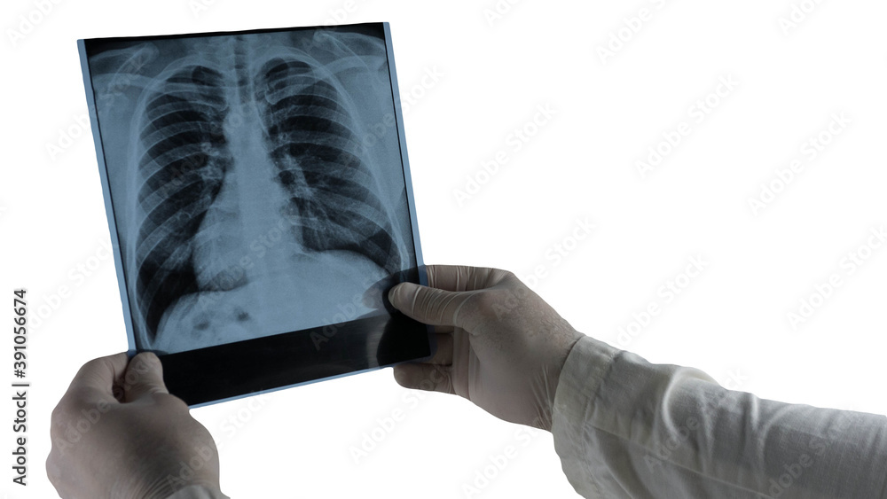 Lung x-ray isolated on white, picture of human lungs, doctor holding x ...