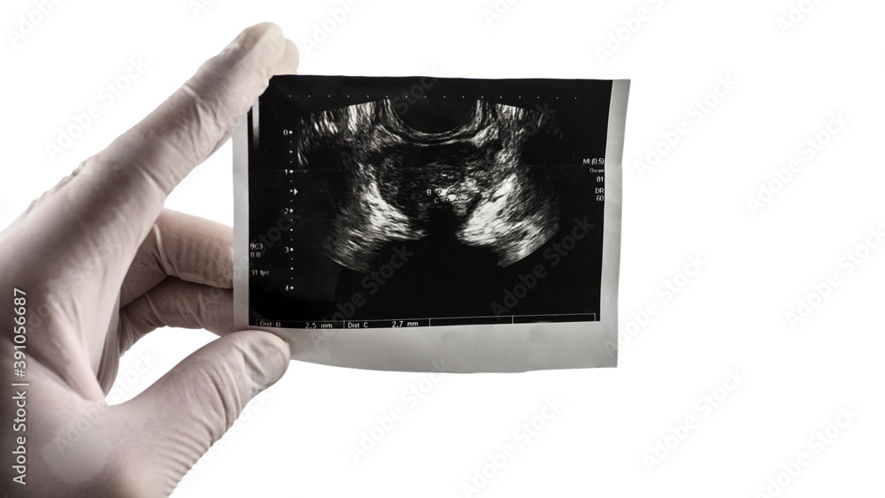 Prostate ultrasound scan on isolated white background, picture of the ...