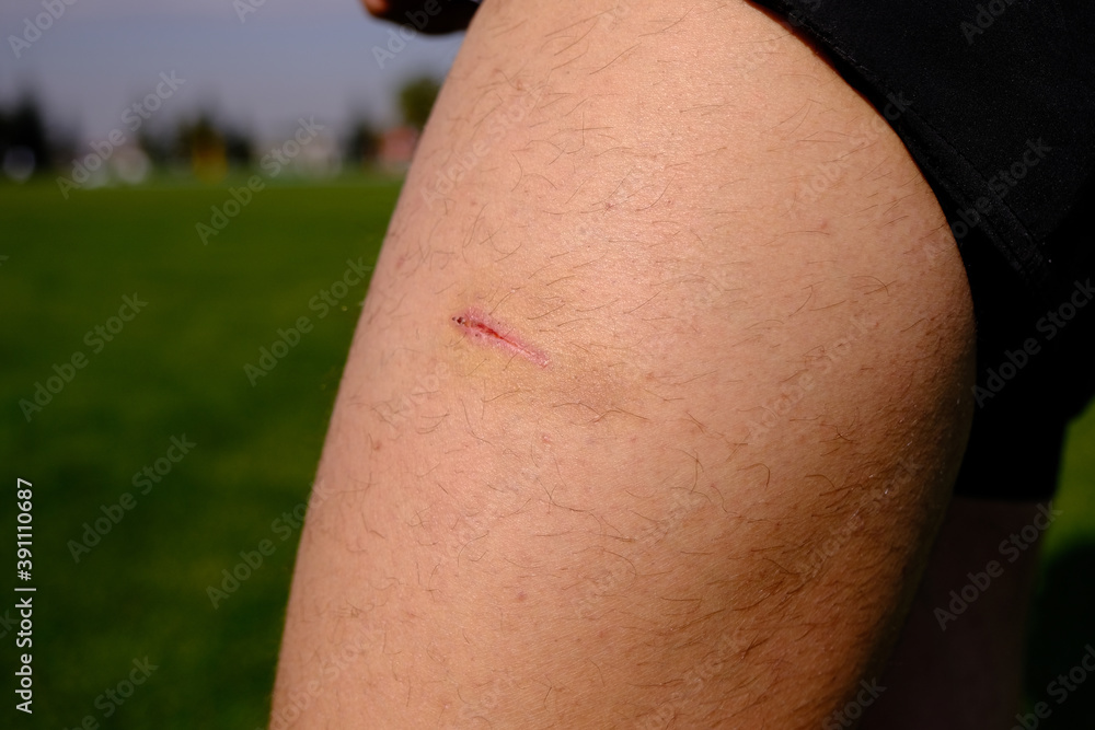 open wound on the leg caused by a scratch. bruises and blackness around ...