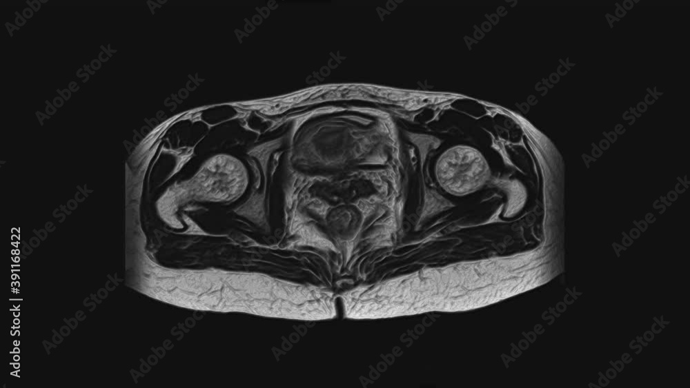Voluminous MRI of the female pelvic organs, abdominal cavity ...