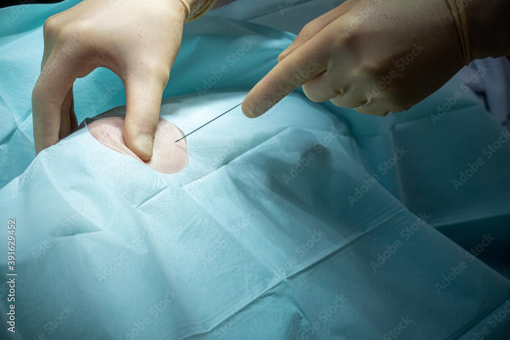 doctor performs a knee puncture in an operating room with a cannula and ...