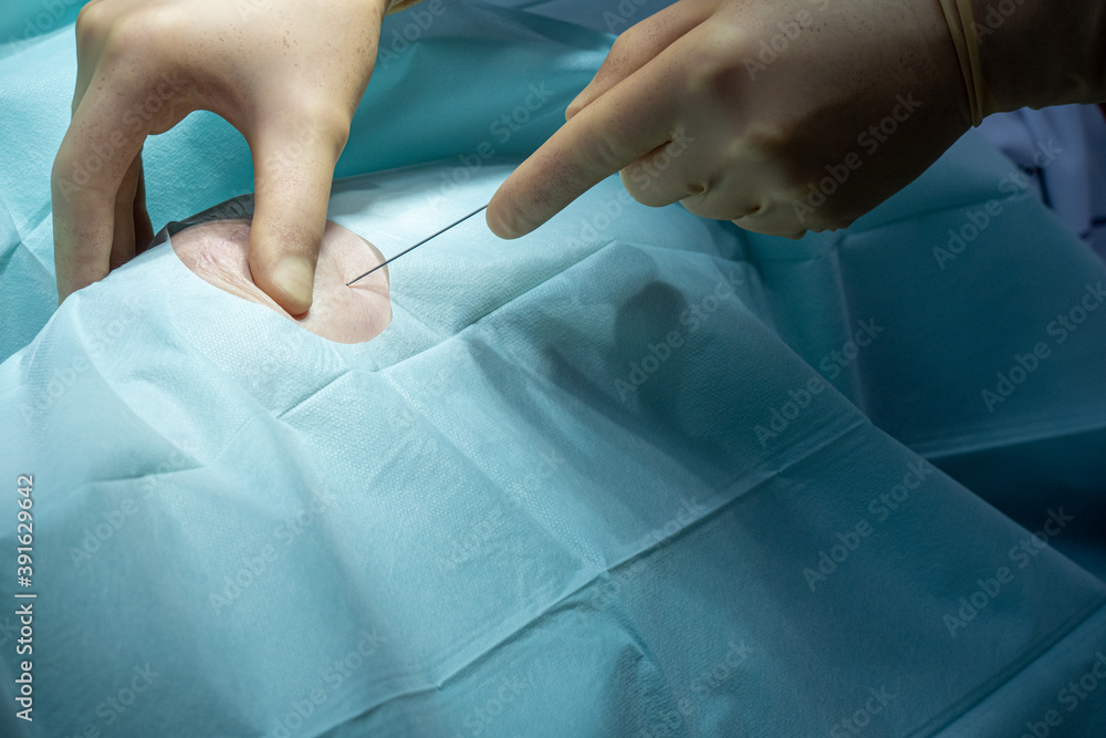 doctor performs a knee puncture in an operating room with a cannula and ...