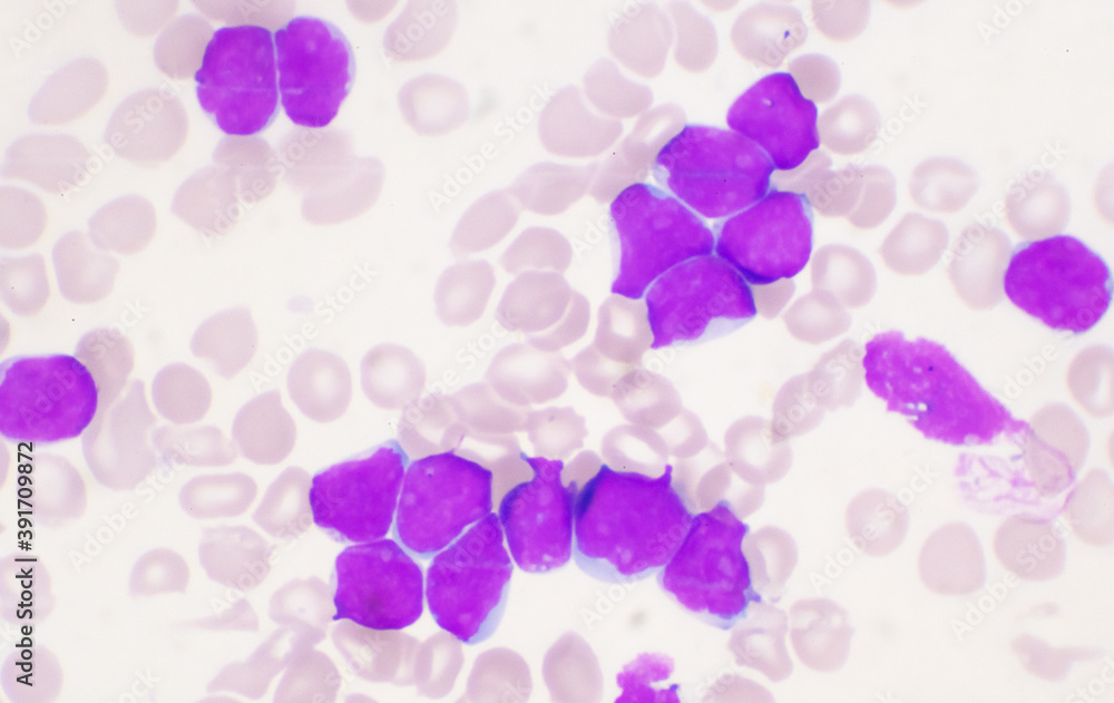 Moderate blast cell of white blood cells in blood smear. Stock Photo ...