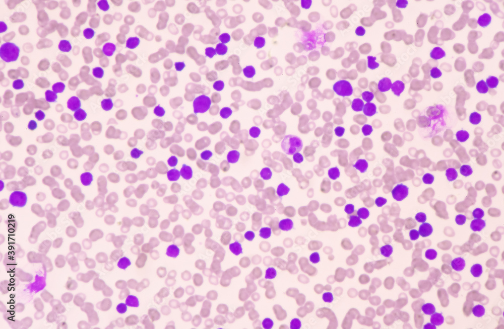 Moderate blast cell of white blood cells in blood smear. Stock Photo ...