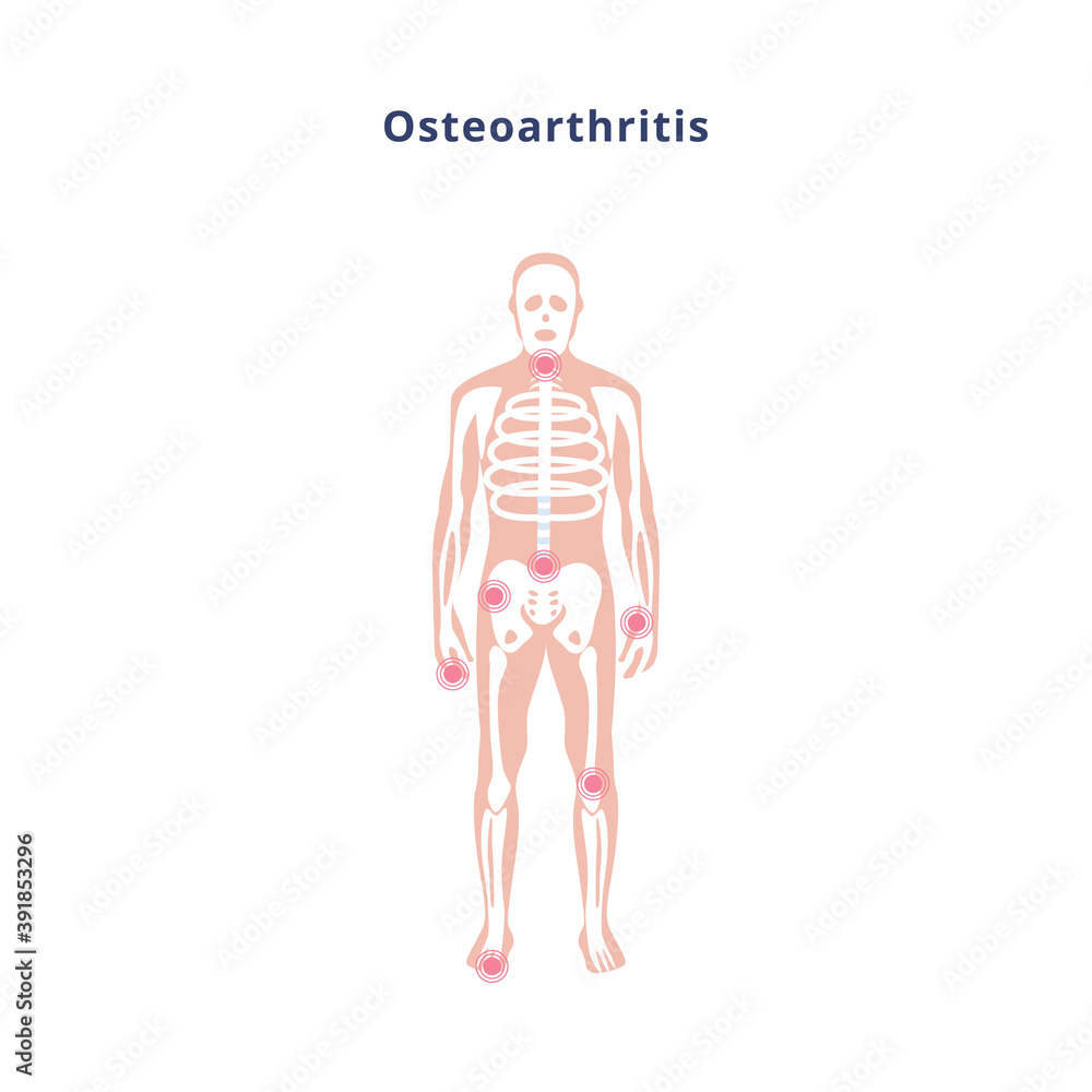 Diagram of body with joint damage by osteoarthritis, flat vector ...