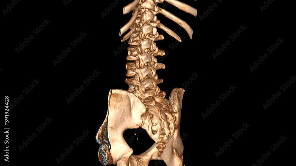 CT scan reconstruction. Lover part of human spine and pelvis. 3D ...