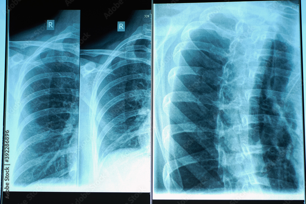 X-ray of the ribs. X-ray image of a person's ribs and spine Stock Photo ...