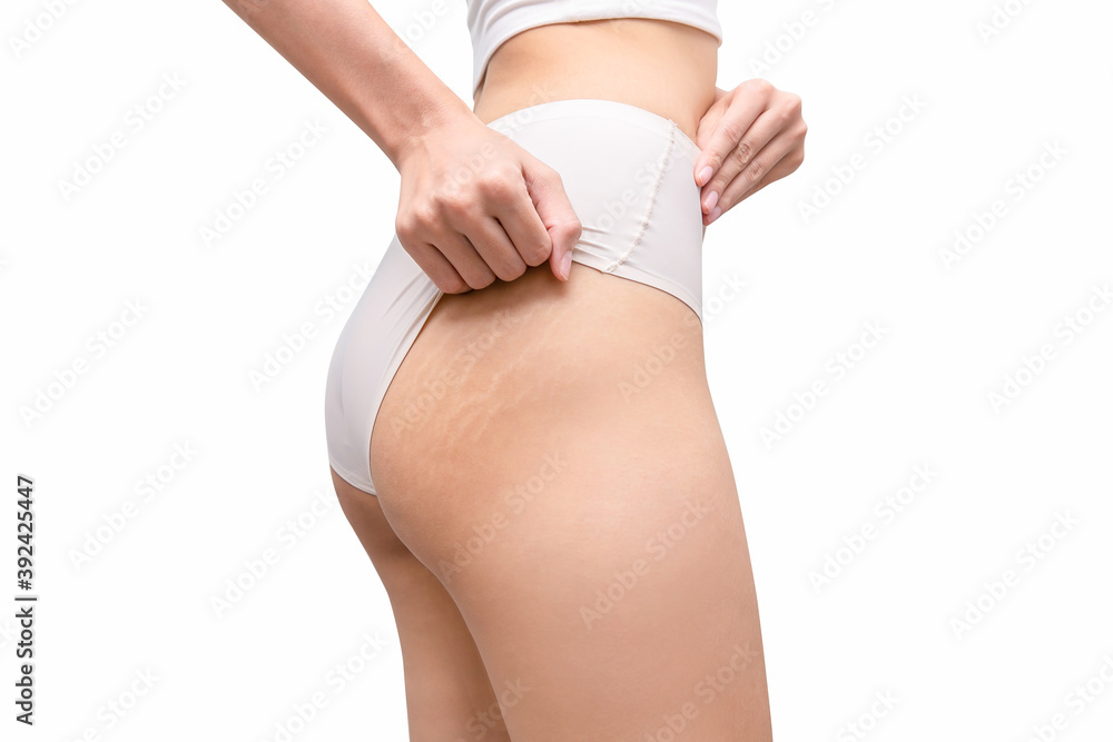 Young women shows holding and pushing the skin of the legs cellulite. Stock Photo | Adobe Stock