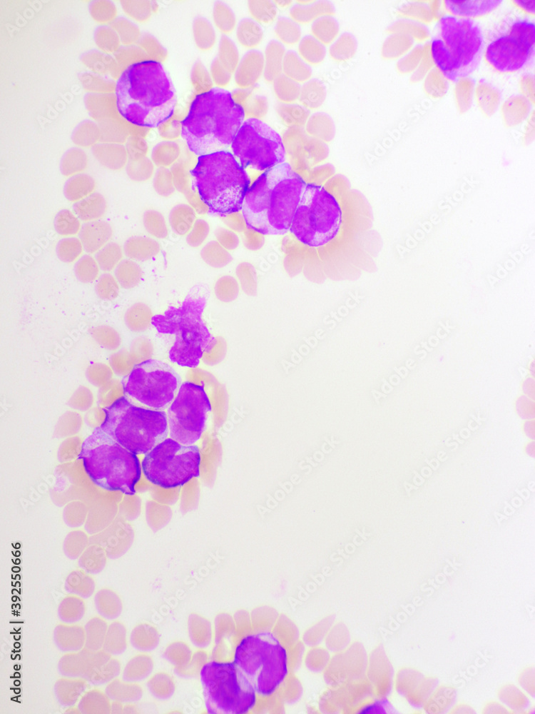 Acute promyelocytic leukemia cells or APL, analyze by microscope ...