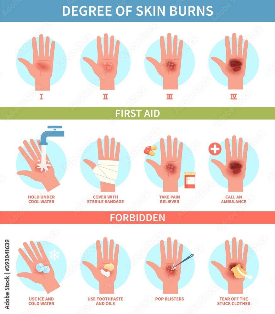 Burns degree. Thermal wound first aid, skin scalds and blisters emergency help. Treatment ...
