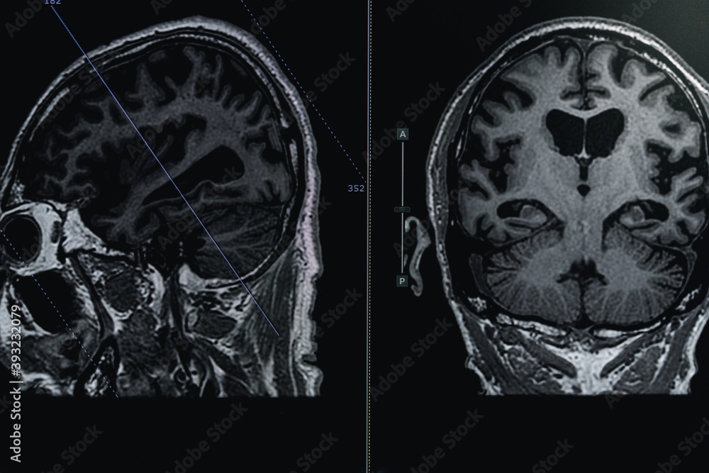 MRI of brain Dementia protocol with Alzheimer's disease Take a picture ...