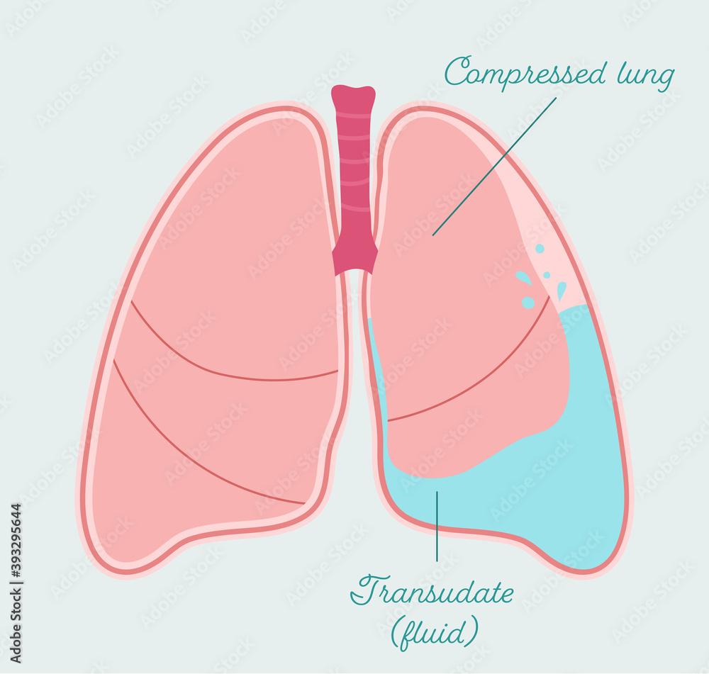 Hydrothorax - anatomical scheme in hand drawn style. Accumulation of ...