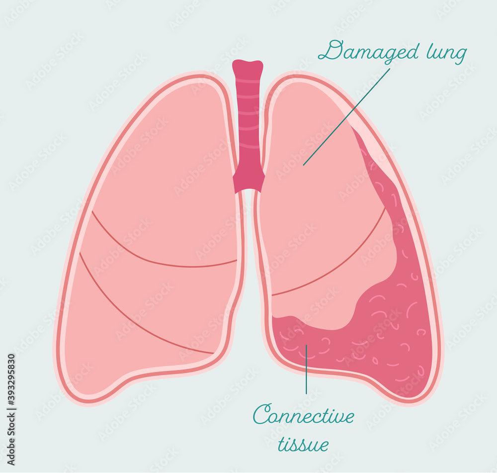Fibrothorax - anatomical scheme in hand drawn style. Fibrosis in ...
