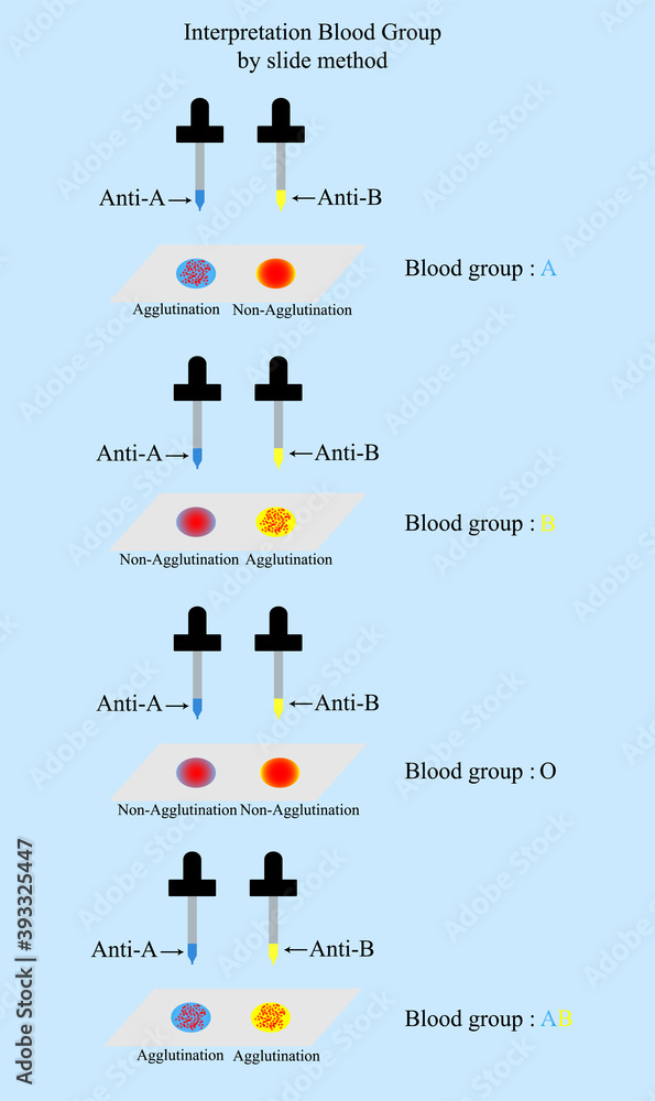 Interpretation blood group in ABO System by slide method in laboratory ...
