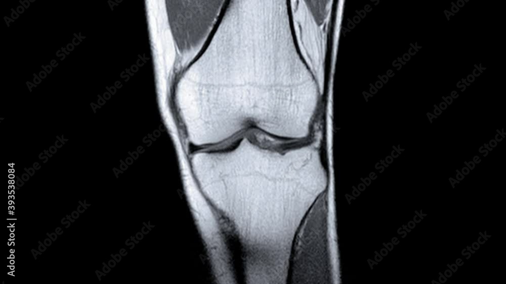 Magnetic resonance imaging (MRI) of left knee. Closed injury of the ...