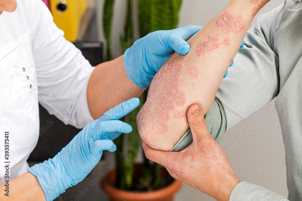A dermatologist wearing gloves examines the skin of a sick patient ...