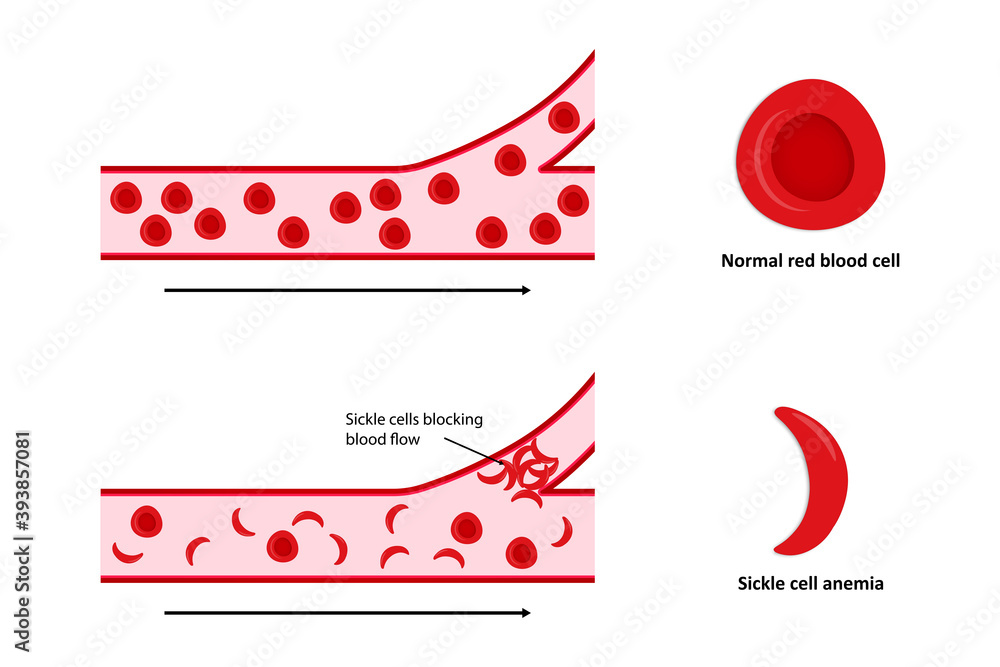 Sickle cell anemia, Comparison of blood flow between Normal red blood ...