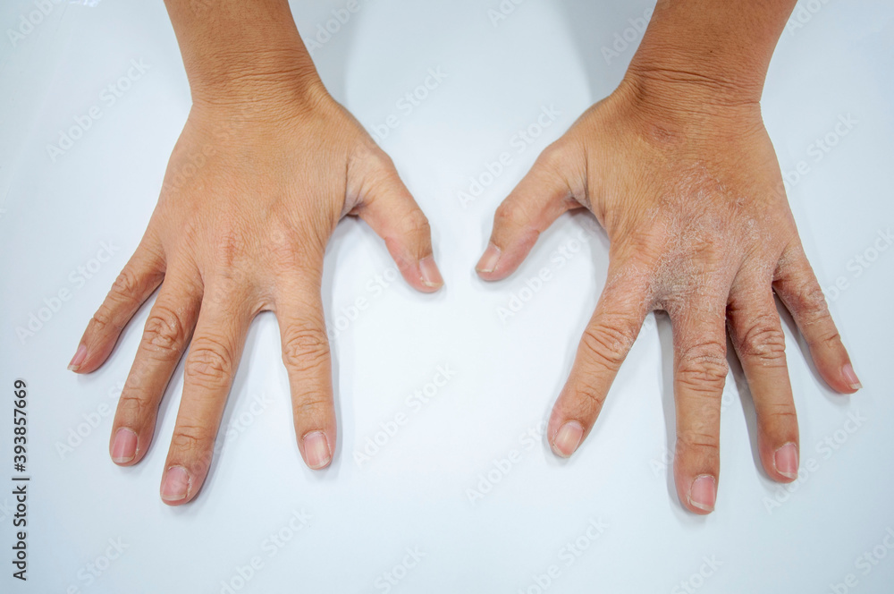 Hands with fungal skin lesions on white.Skin diseases caused by fungi ...