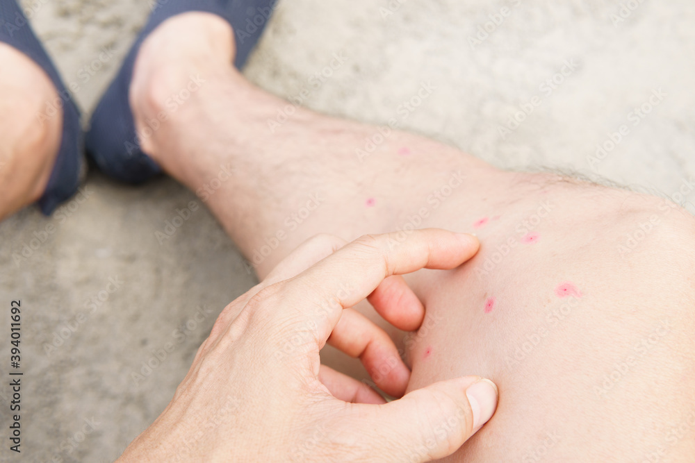 Close up hand of a man scratching with itchiness on the red bumps on ...