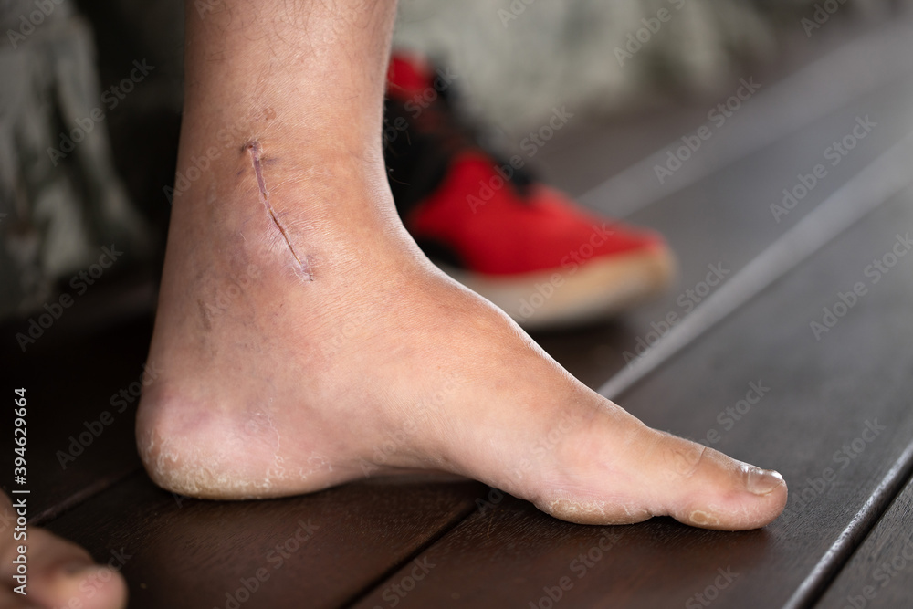 Picture of injured new operation on ankle patient falling from heights ...