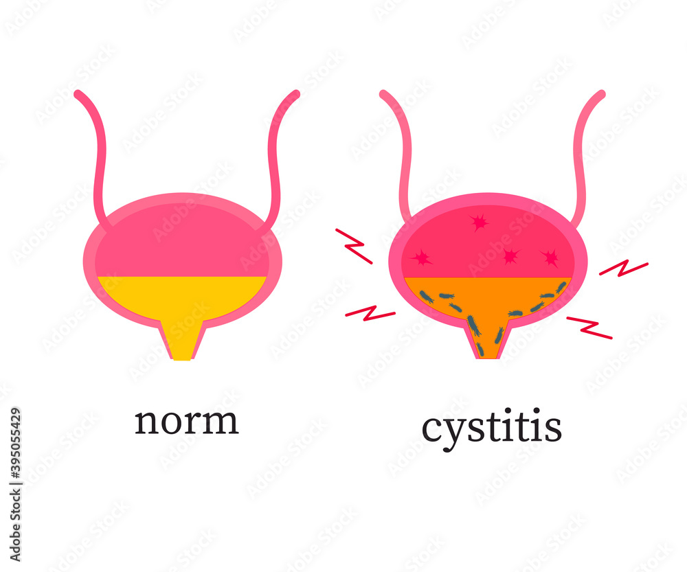 Bladder on a white background. Cystitis. Vector illustration. Stock ...