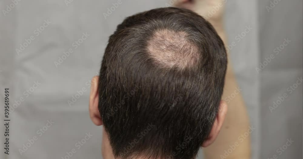 Man with hair loss problems close-up. Alopecia balding hairs on man ...